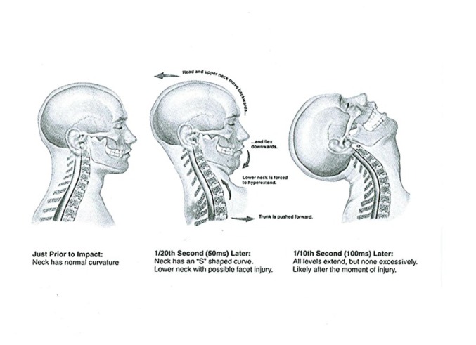 Mesquite Whiplash Injury Doctor | Neck Pain Chiropractor