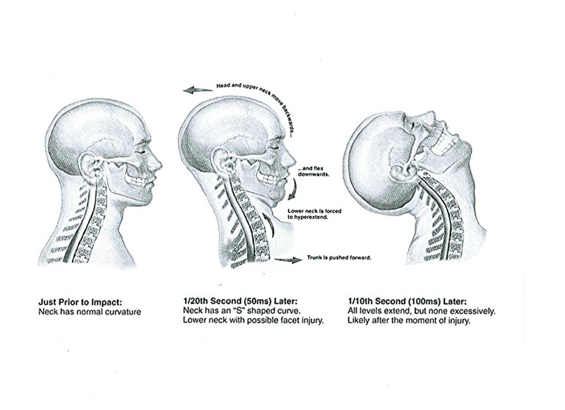 Post Concussion Syndrome Whiplash at Sue Alexander blog